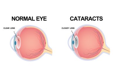 Cataracts - Frankston Eye and Laser Centre